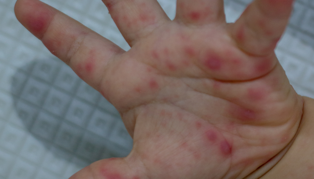 Síndrome mano pie boca – Nerea Pediatra